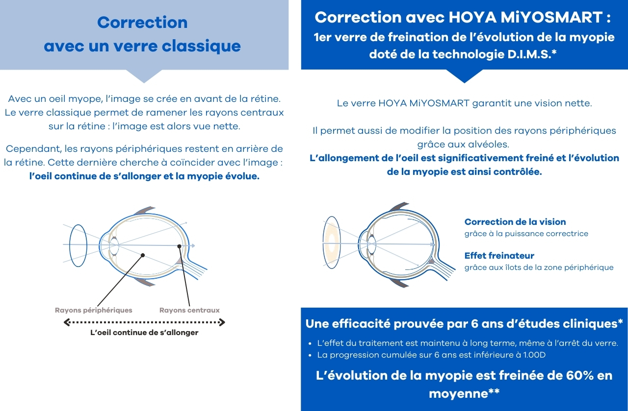 MiYOSMART : le traitement de la myopie chez les enfants.