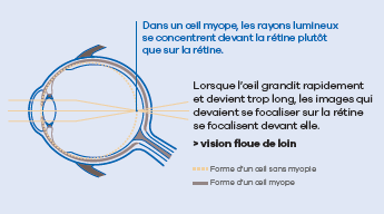 MiYOSMART : le traitement de la myopie chez les enfants.
